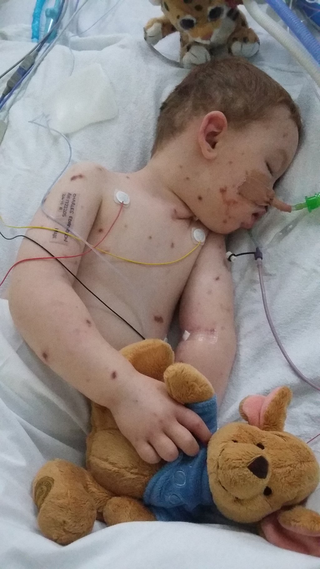 Charlie E's meningitis story | Meningitis Now